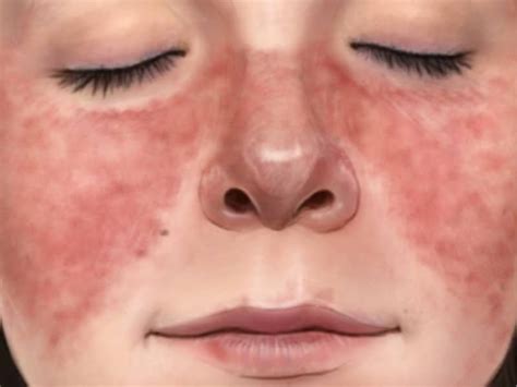 Lupus Vs Rosacea Differences Strong Causes And More 2025