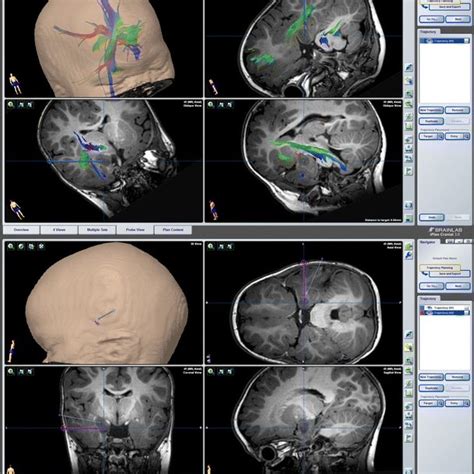 Tractography And Pre Surgical Trajectory Plan On The Brainlab Iplan