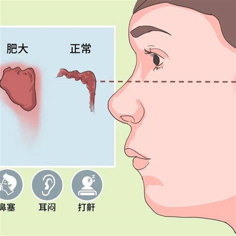 儿童鼾症背后的危害 孩子 淋巴 疾病