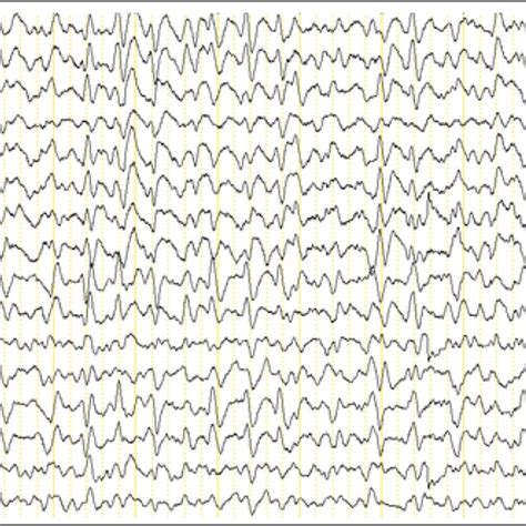 The Synchronous Triphasic Sharp Waves Were Seen In The Frontal