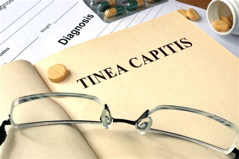 Tinea Capitis Ringworm Hair Loss Erdem Clinic