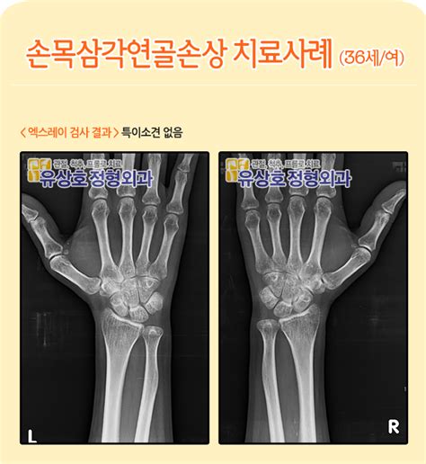 손목 삼각섬유연골 복합체 손상tfcc 치료방법 ♪ 네이버 블로그