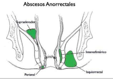 Absceso Perianal Femenino