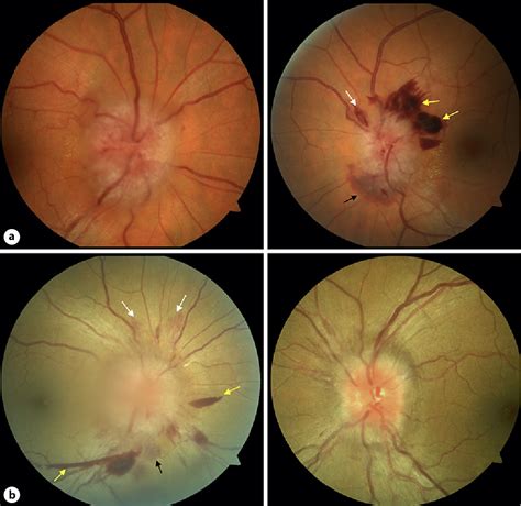 Figure 1 From Three Layered Optic Disc Hemorrhages In Idiopathic