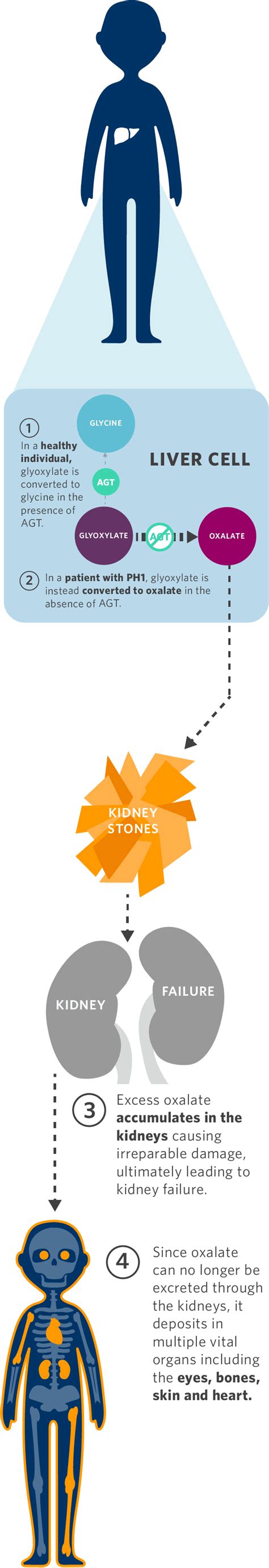Understanding Primary Hyperoxaluria—symptoms And Causes Alnylam®