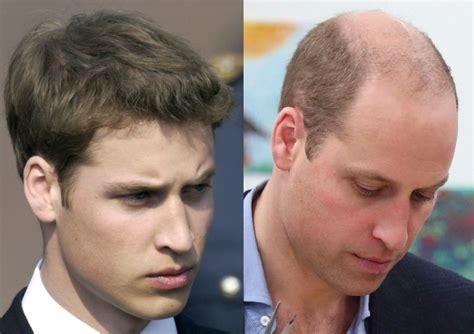 The Impact Of Prince Williams Baldness On His Appearance Justinboey