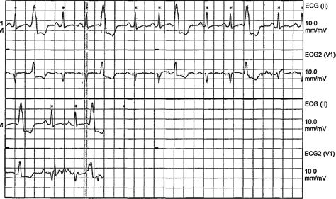 Premature Ventricular Contraction Induced Cardiomyopathy Presenting As