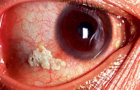 1 Bitots Spots The Foamy Raised Lesion On The Temporal Conjunctiva
