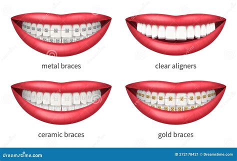 Teeth Braces Set Stock Vector Illustration Of Whitening 272178421