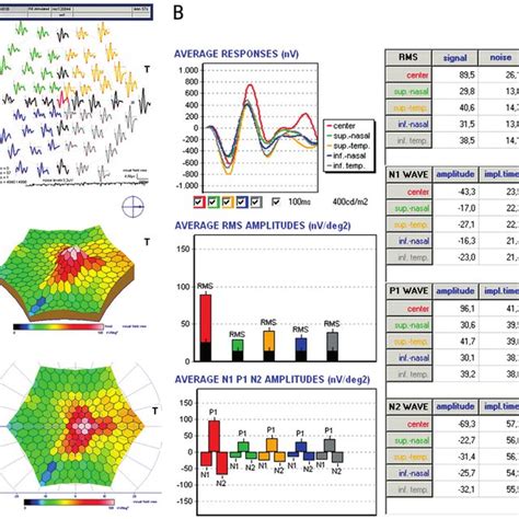 Nir Oct Image Showing Hyperreflective Choroidal Nodules And Download Scientific Diagram