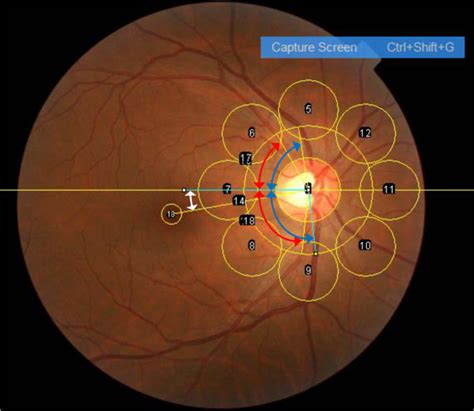 Relationship Between Fundus Sex Index Obtained Using Color Fundus