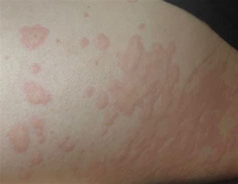 면역력저하 급성두드러기 증상 3일간의 고통 기록 피부과 다녀온 후기 네이버 블로그