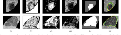 figure 4 from 3d liver tumor segmentation in ct images using improved