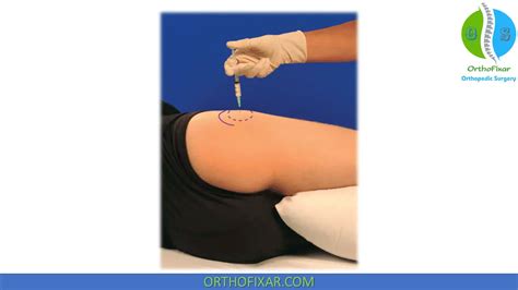 Trochanteric Bursitis Injection