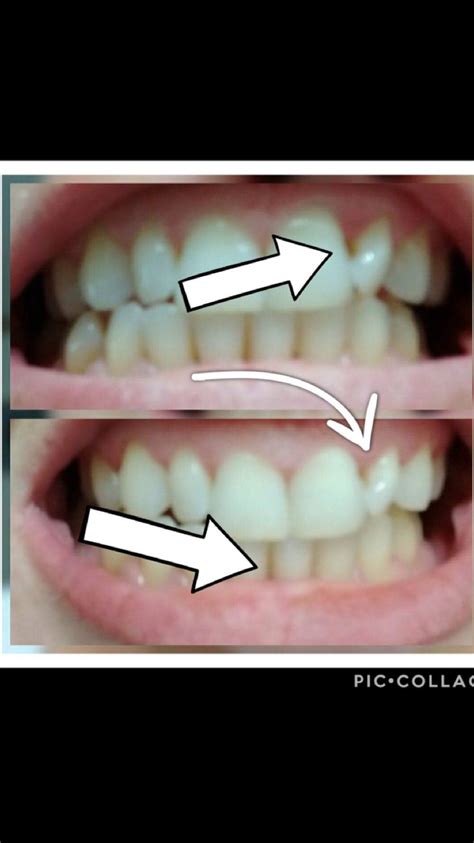 Pin By Shanda Miller Toothpaste Deale On Whitening Toothpaste