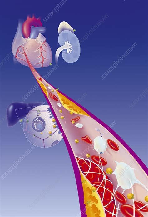 Illustration Of Myocardial Infarction Stock Image C0492257