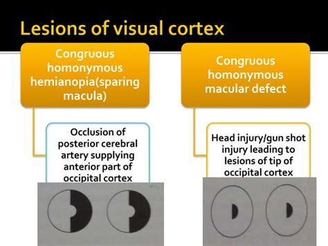 Visual Pathway And Its Defects Pptx