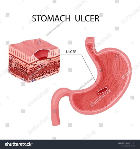 Peptic Ulcer Stomach Detailed Vector Illustration Stock Vector Royalty