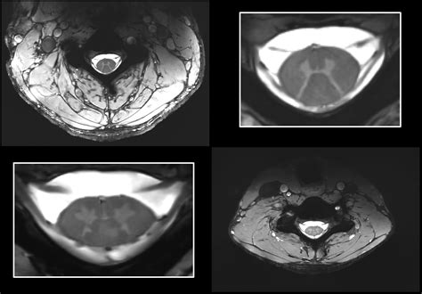 Spinal Cord Imaging Center For Magnetic Resonance In Biology And Medicine