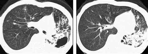 High Resolution Ct At The Admission Revealed Cystic And Varicose