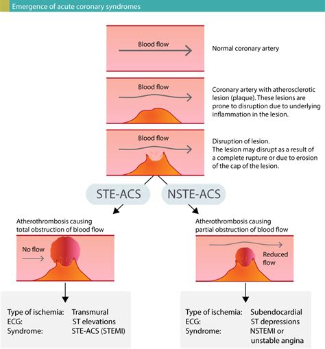 Non Stemi Vs Nstemi