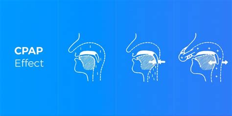CPAP Vs BiPAP What S The Difference Spring 2023