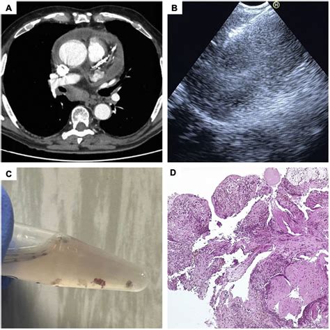 Endobronchial Ultrasound Guided Intranodal Forceps Biopsy Ebus Ifb In