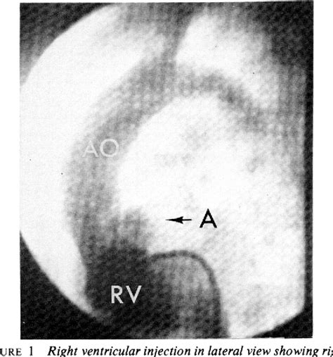 Table 1 From Aneurysm Of The Membranous Ventricular Septum In