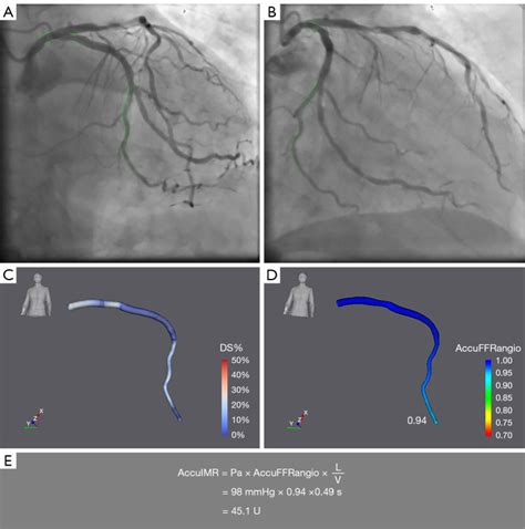 Angiography Based Index Of Microcirculatory Resistance AccuIMR For