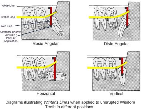 Impacted Mandibular 3rd Molar Classification Complications Indications For Surgical Removal