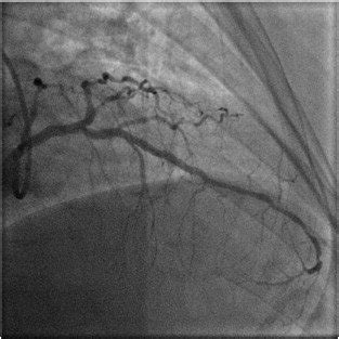 Baseline Angiography Showing Diffuse Lesion In Mid To Distal LAD Artery Download Scientific
