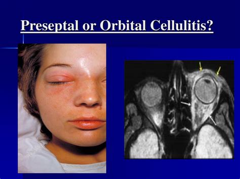 Ppt Posterior Blepharitis Powerpoint Presentation Free Download Id