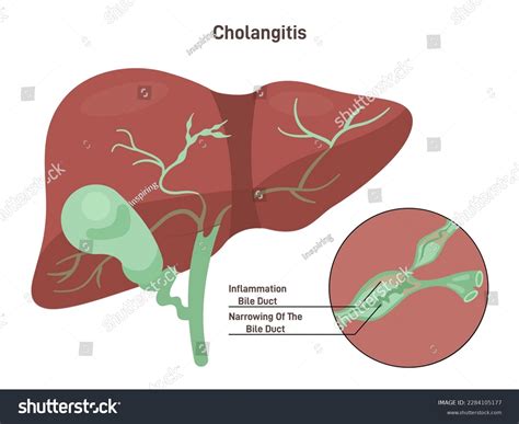 Cholangitis Meaning Bile Duct Diseases Harvard Health