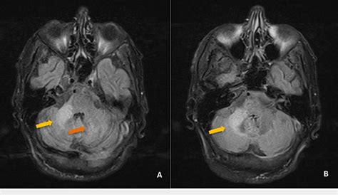 Second Brain Mri 1 Month After The Previous One Transverse T2flair