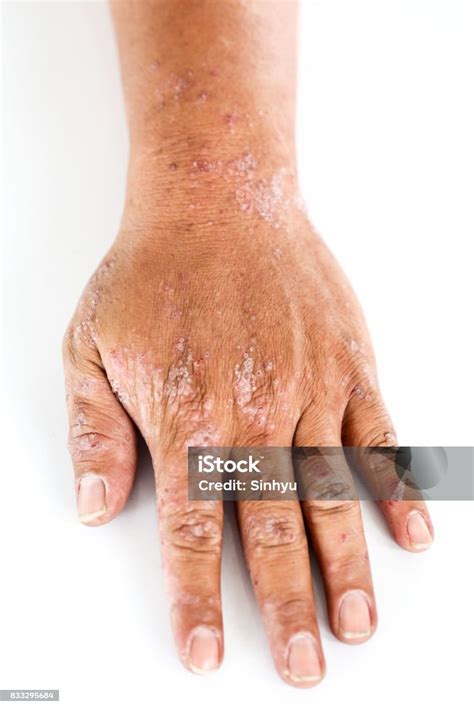 Dermatitis Atopik Foto Stok Unduh Gambar Sekarang Istock