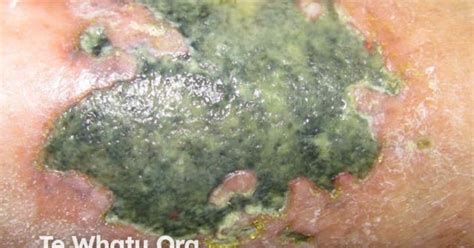 Hydroxyurea Induced Leg Ulcer Image