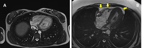 Quantification Of Pericardial Adipose Tissue By Cardiac Magnetic Download Scientific Diagram