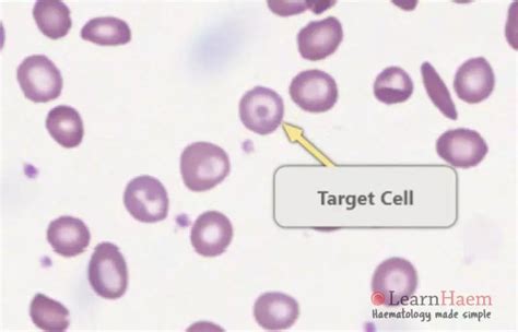 Target Cells Learnhaem Haematology Made Simple