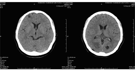 脑囊虫病典型病例分享 经典病例 山东第一医科大学附属消化病医院（省医学科学院第三附属医院） 济宁市首批新农合定点医院 医保定点医院