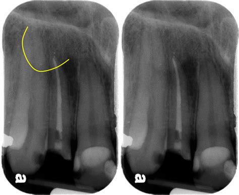 Nasal Fossa X Ray