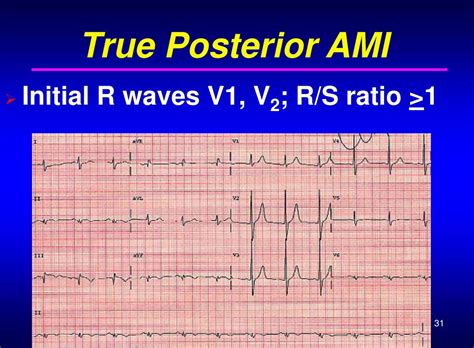 Ppt Ami Acs Diagnosis History And Physical Powerpoint Presentation