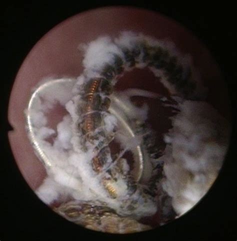 Endoscopic Image Obtained Through A Rigid Nephroscope Demonstrating An Download Scientific