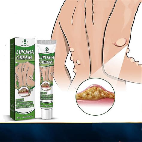 Lipoma Removal Cream Relief Pain Treat Skin Swelling Lipolysis