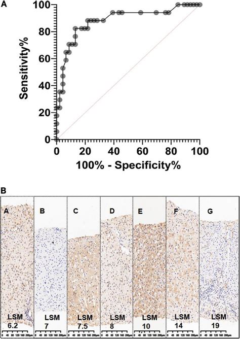 The Sensitivity And Specificity Of Two Dimensional Shear Wave