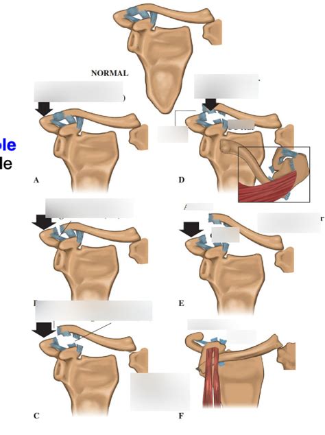 Diagram Of Ac Jt Seperation Grades Quizlet