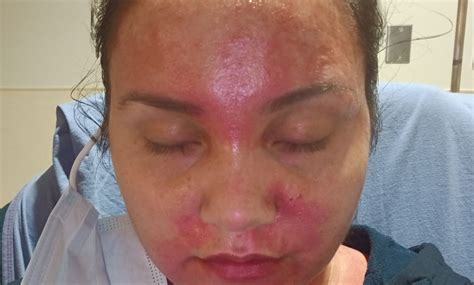 Stress Rash On Face