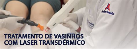 TRATAMENTO DE VASINHOS LASER TRANSDÉRMICO Blog Dr Alex