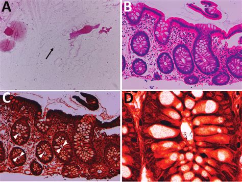 Microscopic Findings In Ileocolonic Biopsy Specimens Second