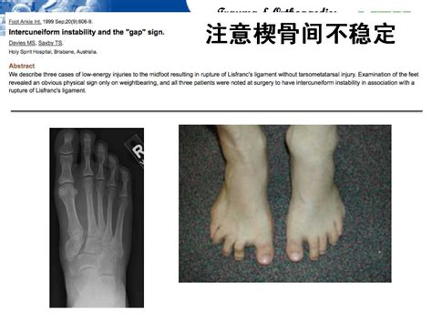 Lisfranc损伤的手术治疗 医学文章 唯医 allinmd