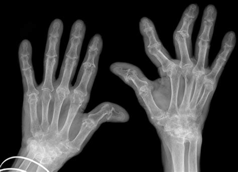 Rheumatoid Arthritis Causes Genetics Age Stress And More